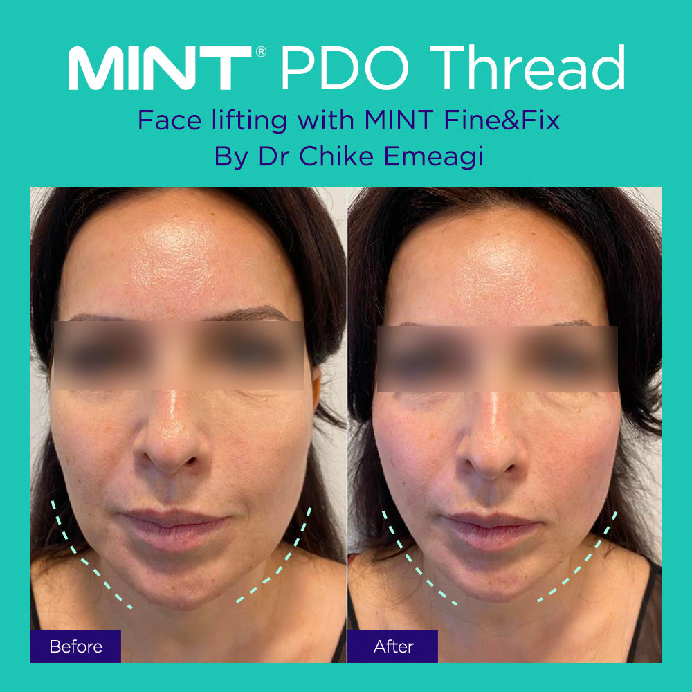 Face Treatment - MINT™ PDO & Klàrdie Manufacturer – MINT™ PDO & Klárdie Manufacturer