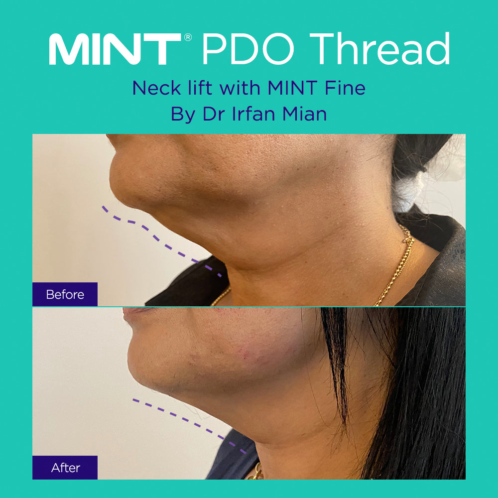 Neck Treatment - MINT™ PDO & Klàrdie Manufacturer – MINT™ PDO & Klárdie Manufacturer