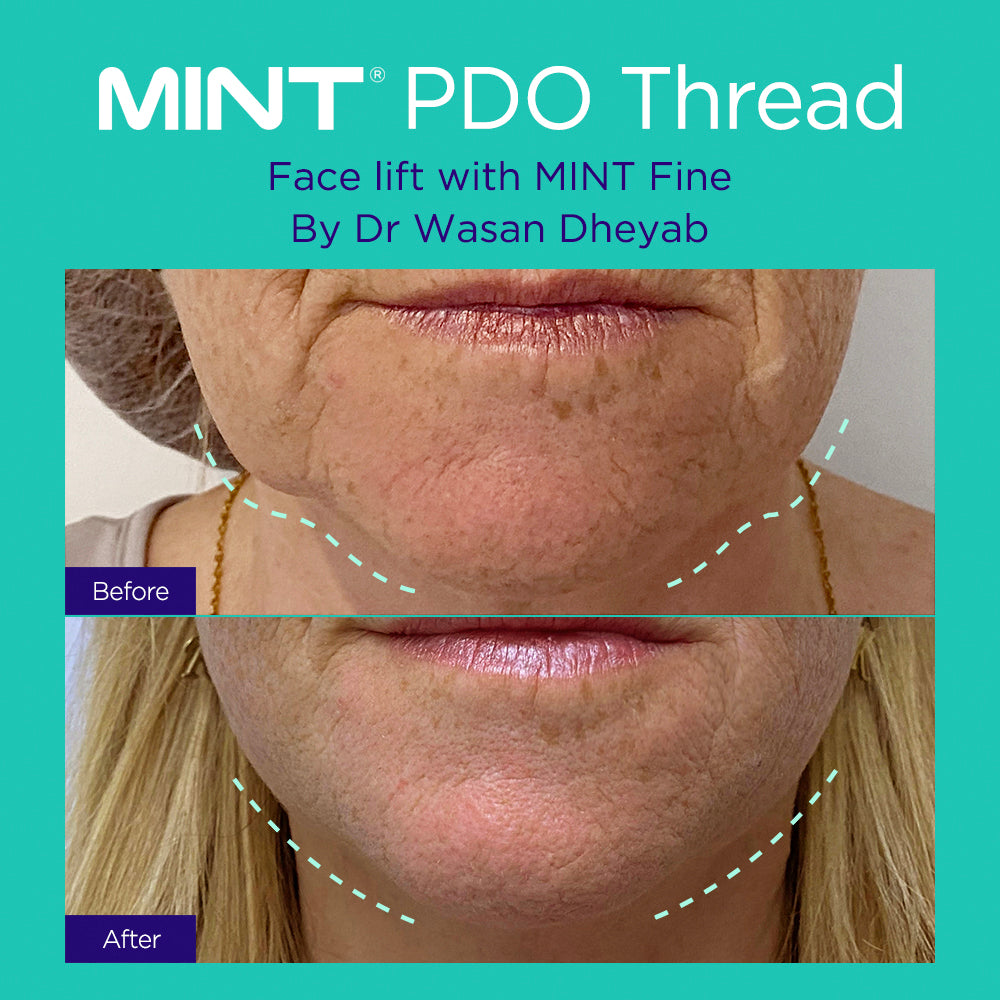 Face Treatment - MINT™ PDO & Klàrdie Manufacturer – MINT™ PDO & Klárdie ...