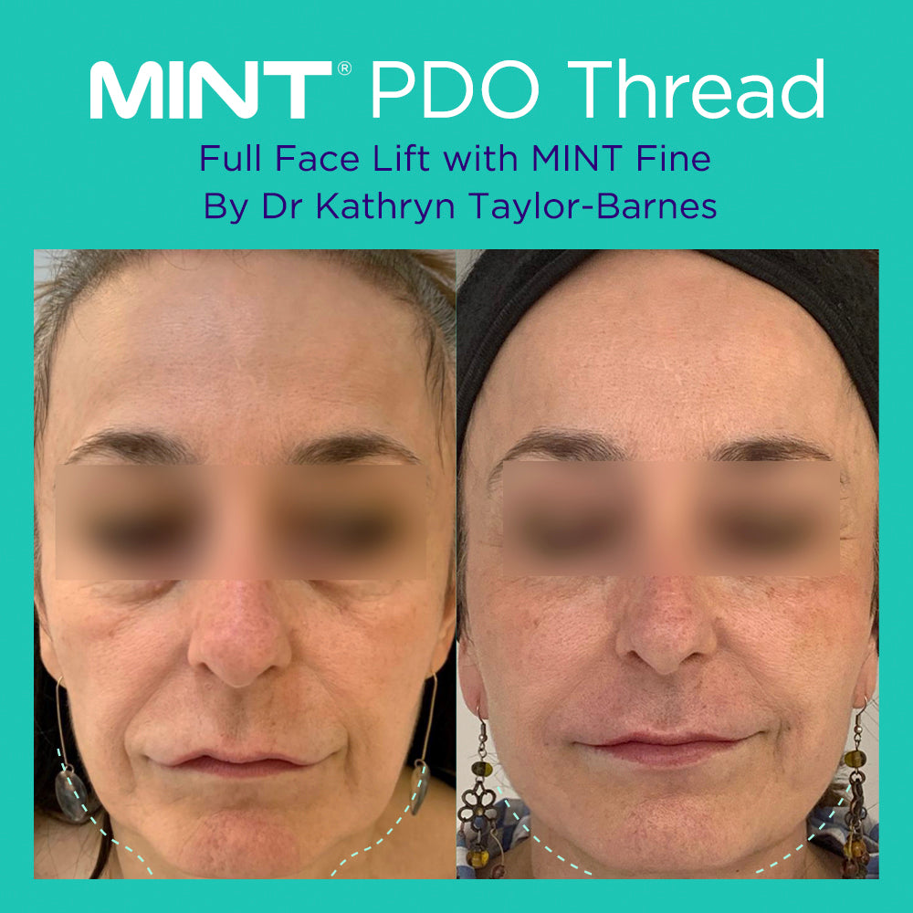 Face Treatment - MINT™ PDO & Klàrdie Manufacturer – MINT™ PDO & Klárdie ...