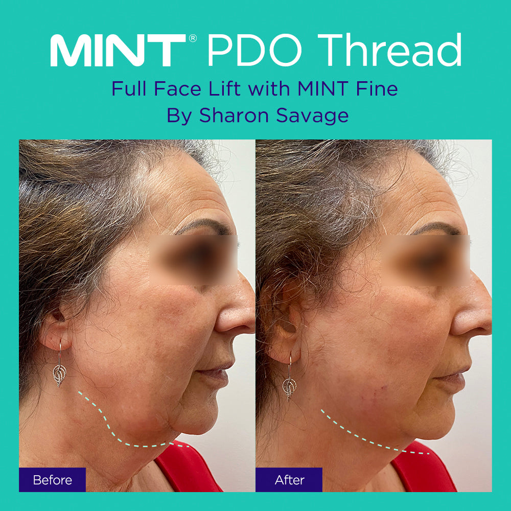 Face Treatment - MINT™ PDO & Klàrdie Manufacturer – MINT™ PDO & Klárdie ...