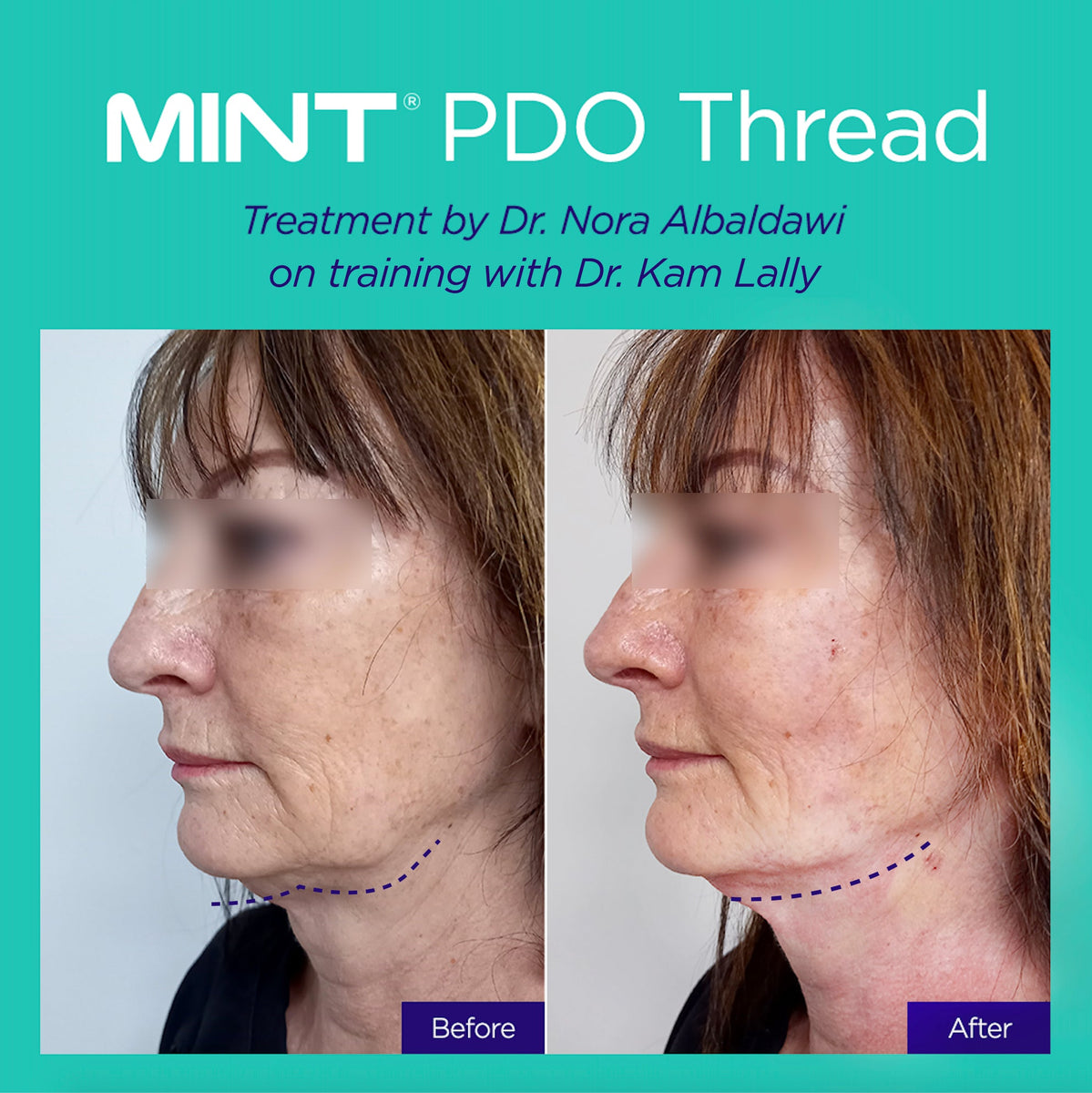 Face Treatment - MINT™ PDO & Klàrdie Manufacturer – MINT™ PDO & Klárdie ...