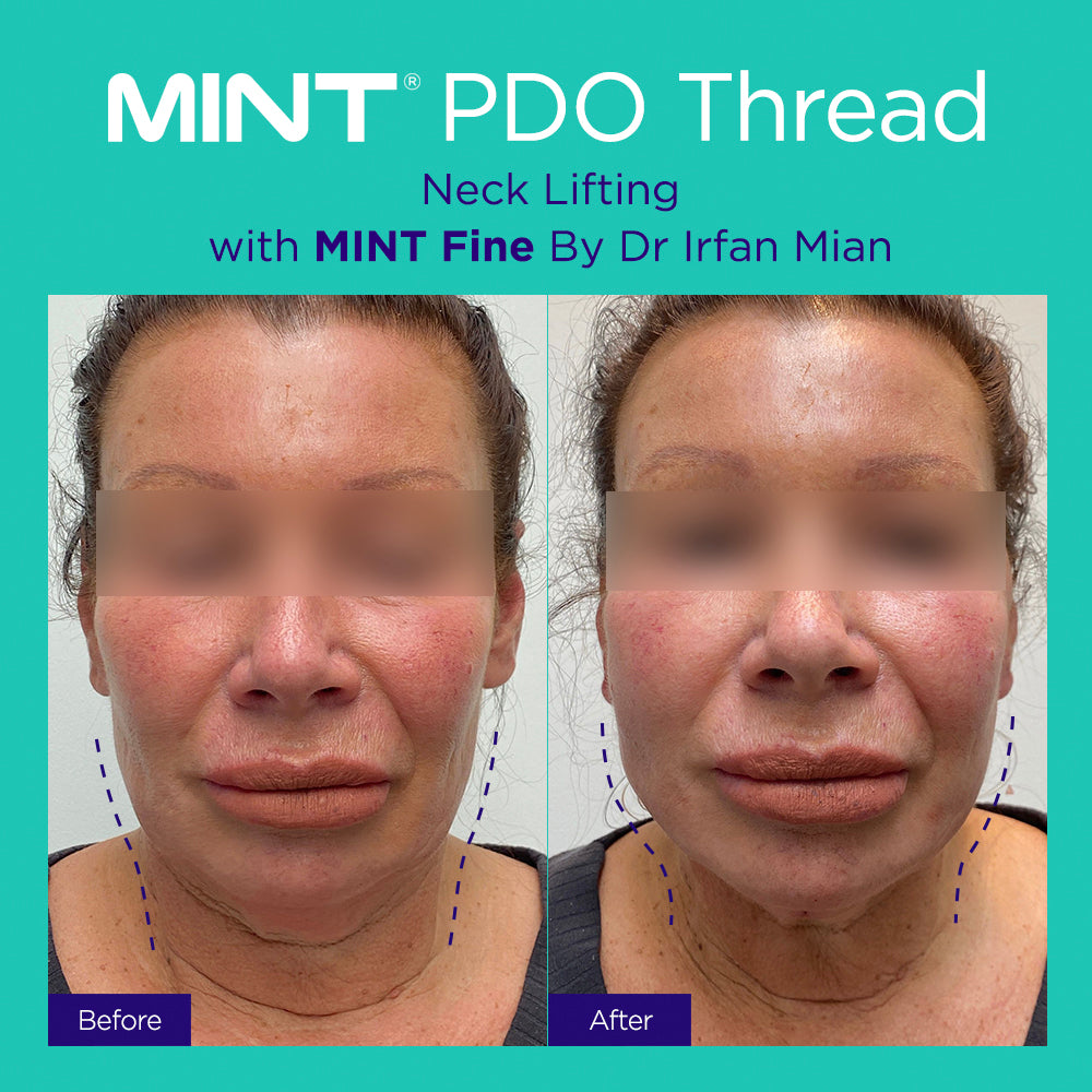 Neck Treatment - MINT™ PDO & Klàrdie Manufacturer – MINT™ PDO & Klárdie ...